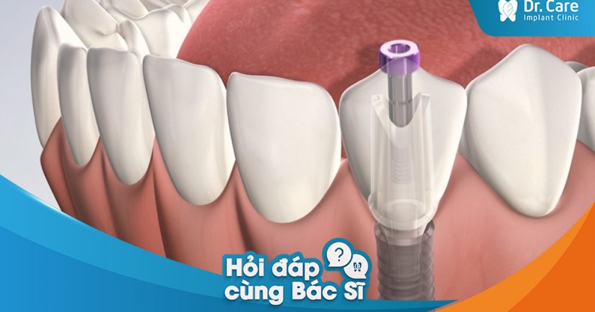 Vì sao nên cần lựa chọn trụ Implant kỹ lưỡng trước khi trồng răng ...