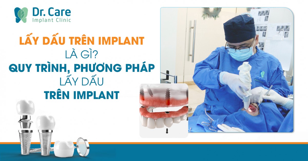 Lấy dấu Implant là gì? Quy trình và phương pháp thực hiện | Dr. Care