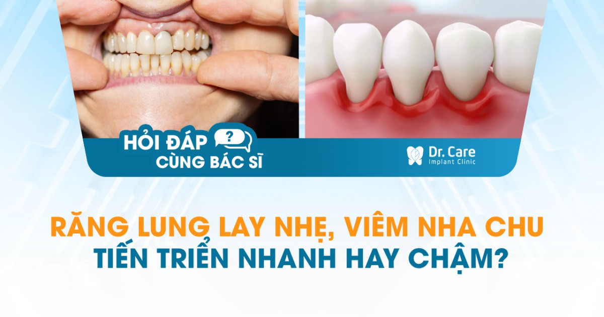 [HỎI ĐÁP BÁC SĨ] – Răng lung lay nhẹ, viêm nha chu tiến triển nhanh hay ...