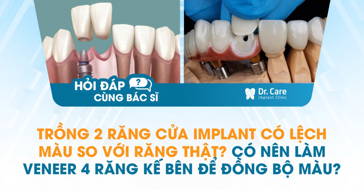 [HỎI ĐÁP BÁC SĨ] – Trồng 2 răng cửa Implant có bị lệch màu so với răng ...