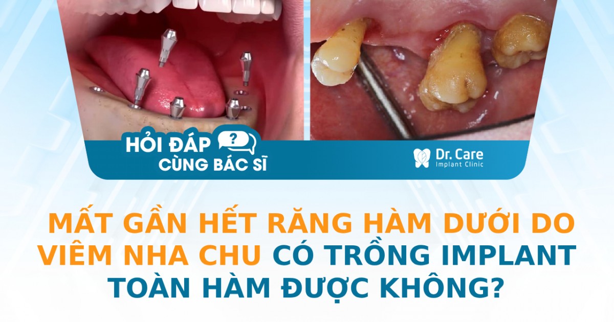 [HỎI ĐÁP BÁC SĨ] - Mất gần hết răng hàm dưới do viêm nha chu có trồng ...